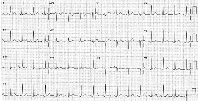 ECG Challenge: College Swimmer With Concerning ECG