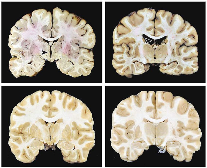 CTE Common Among Young Athletes in Largest Brain Donor Study