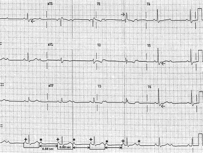 ECG Challenge: Slow Heart and Cellulitis - Page 2