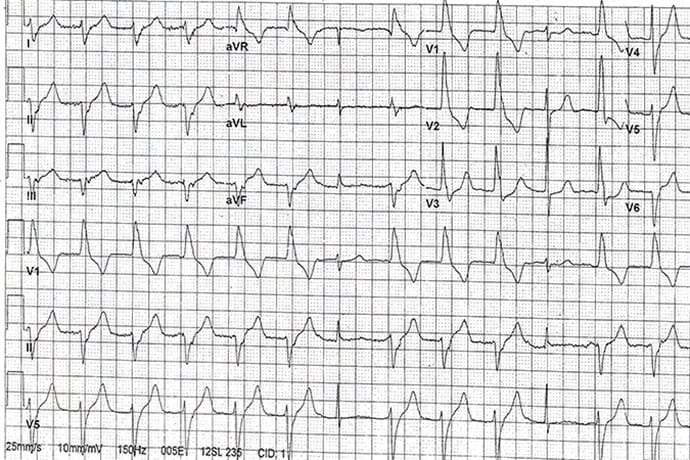 ECG Challenge: Fever After Oral Surgery in a Cardiac Patient
