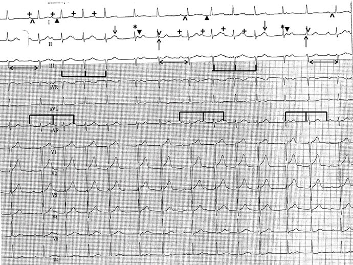 ECG Challenge: COPD Flare-Up and Irregular Heartbeat - Page 2