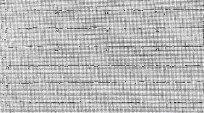 Occasional Lightheadedness and Concerning ECG