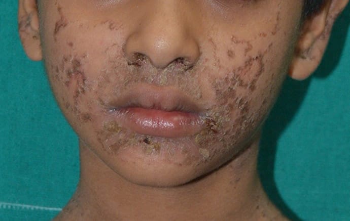 A 7-Year-Old With a Rash on Her Face and Extremities Present Since ...