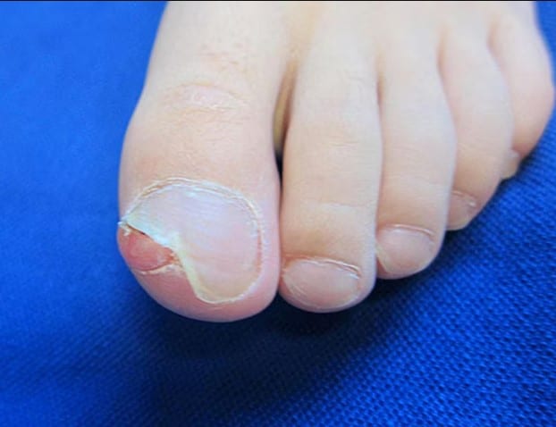 An Unusual Acquired Nodule Over the Toe