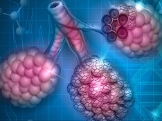 Interstitial (Nonidiopathic) Pulmonary Fibrosis: Practice Essentials ...