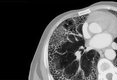 Idiopathic Pulmonary Fibrosis (IPF): Practice Essentials, Background ...