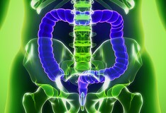 Big Difference in Colorectal Cancer on Right vs Left Side