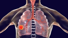 Multaq (dronedarone) dosing, indications, interactions, adverse effects ...