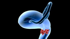 Cervical Cancer Imaging: Practice Essentials, Computed Tomography (CT ...