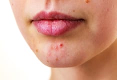 Gram-Negative Folliculitis: Background, Pathophysiology, Etiology