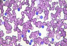 Beta2 Microglobulin: Reference Range, Interpretation, Collection and Panels