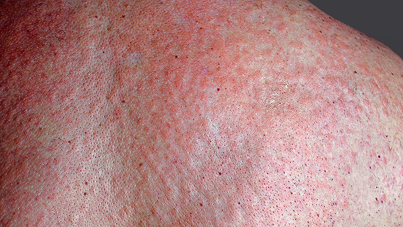 Psoriasis | Medscape
