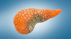 Pancreatic Cancer: Practice Essentials, Pathophysiology, Etiology