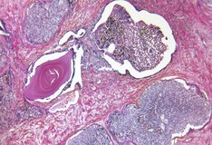 Scrotal Rash in an Elderly Man