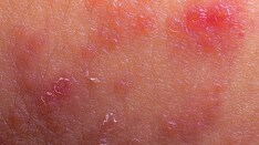 Atopic Dermatitis Differential Diagnoses