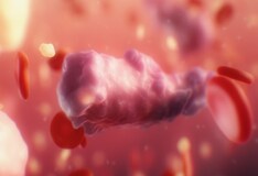 Thrombotic Thrombocytopenic Purpura (TTP): Practice Essentials ...