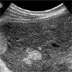 Multiple Hepatic Adenomas
