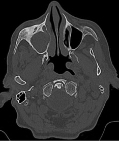 Sphenoidotomy Technique: Approach Considerations, Lavage of the ...