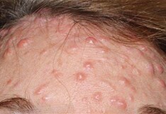 Trichoepithelioma Workup: Approach Considerations, Procedures ...