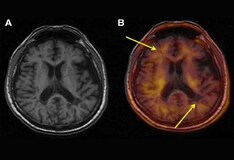 Neuraceq (florbetaben F 18) dosing, indications, interactions, adverse ...