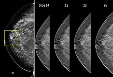 Imaging of Benign Breast Calcifications: Overview, Mammogram
