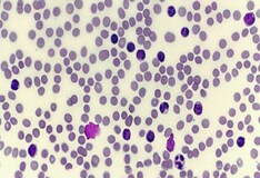 Hypogammaglobulinemia Clinical Presentation: History, Physical, Causes