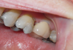 Arestin (minocycline dental) dosing, indications, interactions, adverse ...