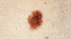 Atypical Mole (Clark Nevus or Dysplastic Nevus): Practice Essentials ...