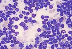 Oncaspar, PEG L Asparaginase (pegaspargase) dosing, indications ...