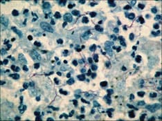 Nocardiosis: Background, Pathophysiology, Epidemiology