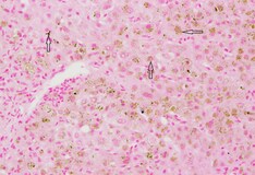 Wilson Disease Workup: Approach Considerations, Serum Ceruloplasmin ...