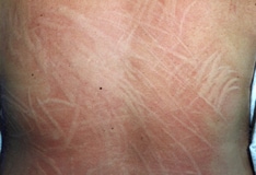 Dermographism Urticaria: Background, Pathophysiology and Etiology ...