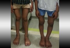 Rickets: Background, Pathophysiology, Epidemiology