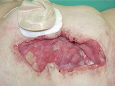 Xerava (eravacycline) dosing, indications, interactions, adverse ...