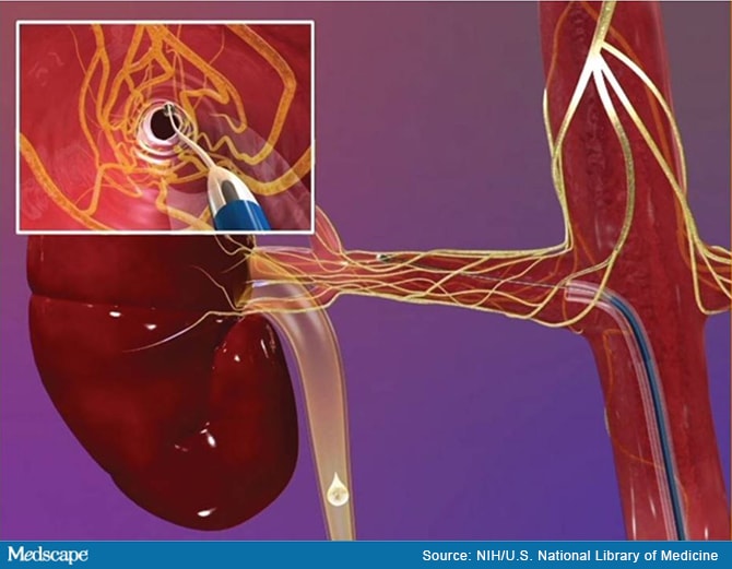 Renal Denervation: Is It Ready for Prime Time?