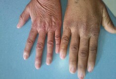 Gigantism and Acromegaly: Practice Essentials, Background ...