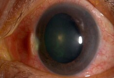 A-Scan Biometry: Ultrasound Principles, Ultrasound Biometry ...