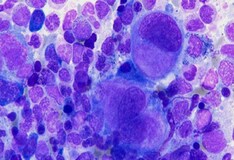 Primary Myelofibrosis Workup: Complete Blood Count, Imaging Studies ...