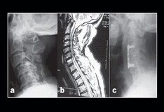Intrinsic Plus Hand: Background, Anatomy, Pathophysiology