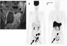Gynecologic Tumor Markers: Tumor Marker Overview, Cancer Antigen 125 ...