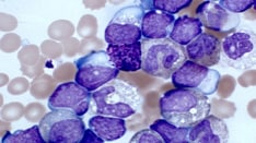 Chronic Myelogenous Leukemia (CML) Workup: Approach Considerations ...