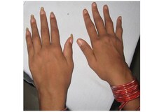 Boutonniere (Buttonhole) Deformity: Background, Anatomy, Pathophysiology