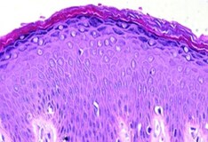Vulvar Biopsy: Overview, Periprocedural Care, Technique