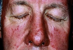 Rosacea: Practice Essentials, Background, Pathophysiology