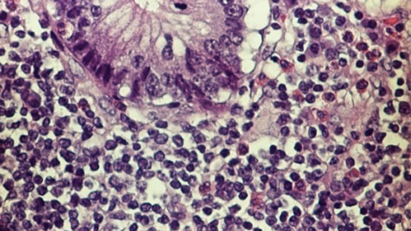 Multiple Myeloma | Medscape