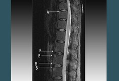 Reactive Arthritis Imaging: Practice Essentials, Radiography, Computed ...