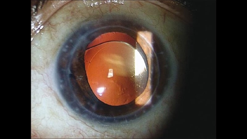 Cataract and Refractive Surgery | Medscape