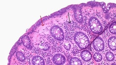 Microscopic Colitis (Collagenous and Lymphocytic Colitis): Background ...