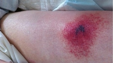 Capvaxive (pneumococcal vaccine 21-valent) dosing, indications ...