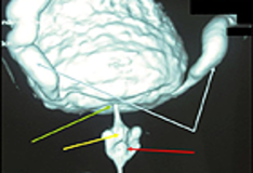 Posterior Urethral Valves Treatment & Management: Approach ...